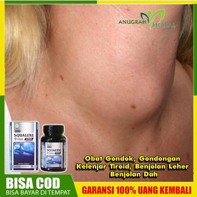 Jual Obat Gondok Beracun Menahun, Gondongan di leher, Kelenjar Tiroid ...