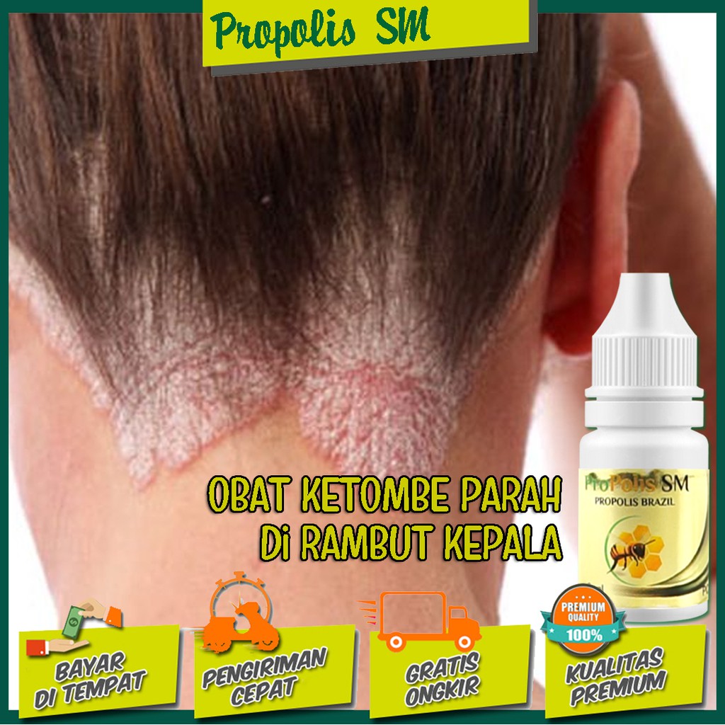 Jual Obat Ketombe Parah di Rambut - Ketombe Basah - Ketombe Kering - Gatal Karena Ketombe di ...