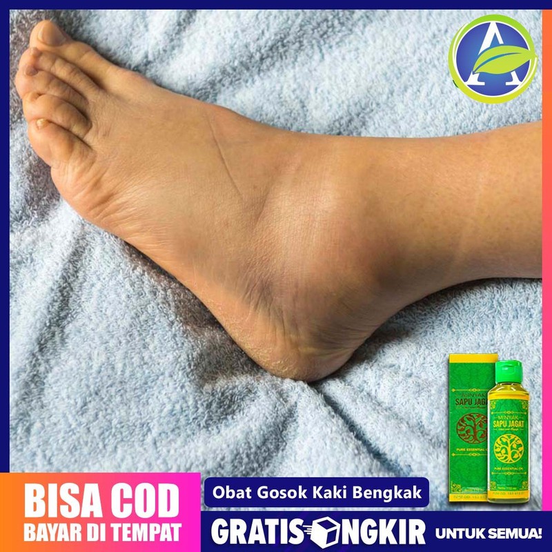 Jual Obat Kaki Bengkak, Kaki bengkak Karena Diabetes MINYAK SAPU JAGAT ...