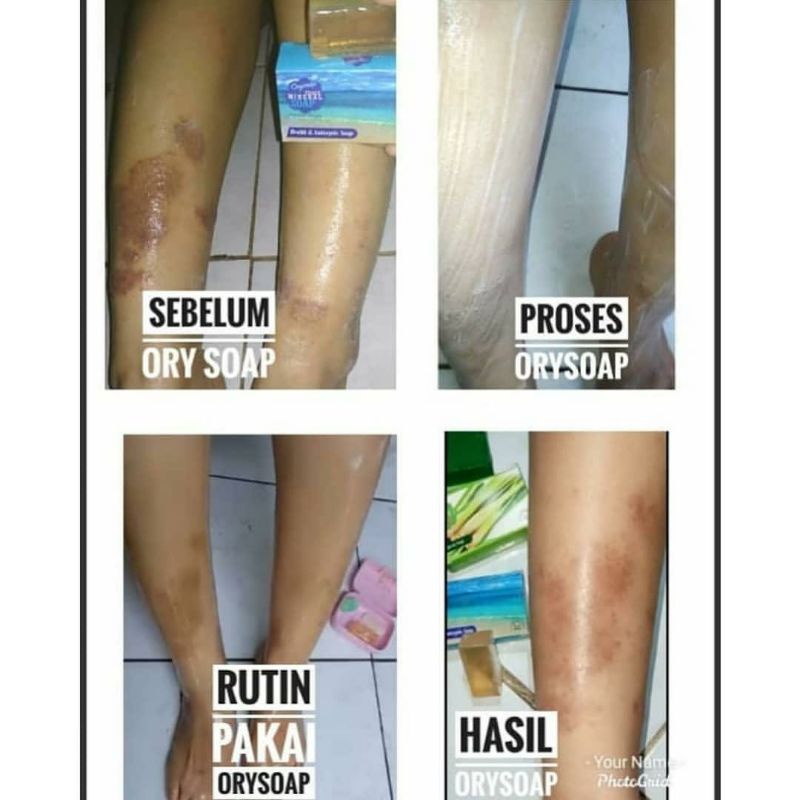 Jual SABUN GATAL KULIT PALING AMPUH UNTUK ANAK DAN DEWASA / HILANGKAN ...