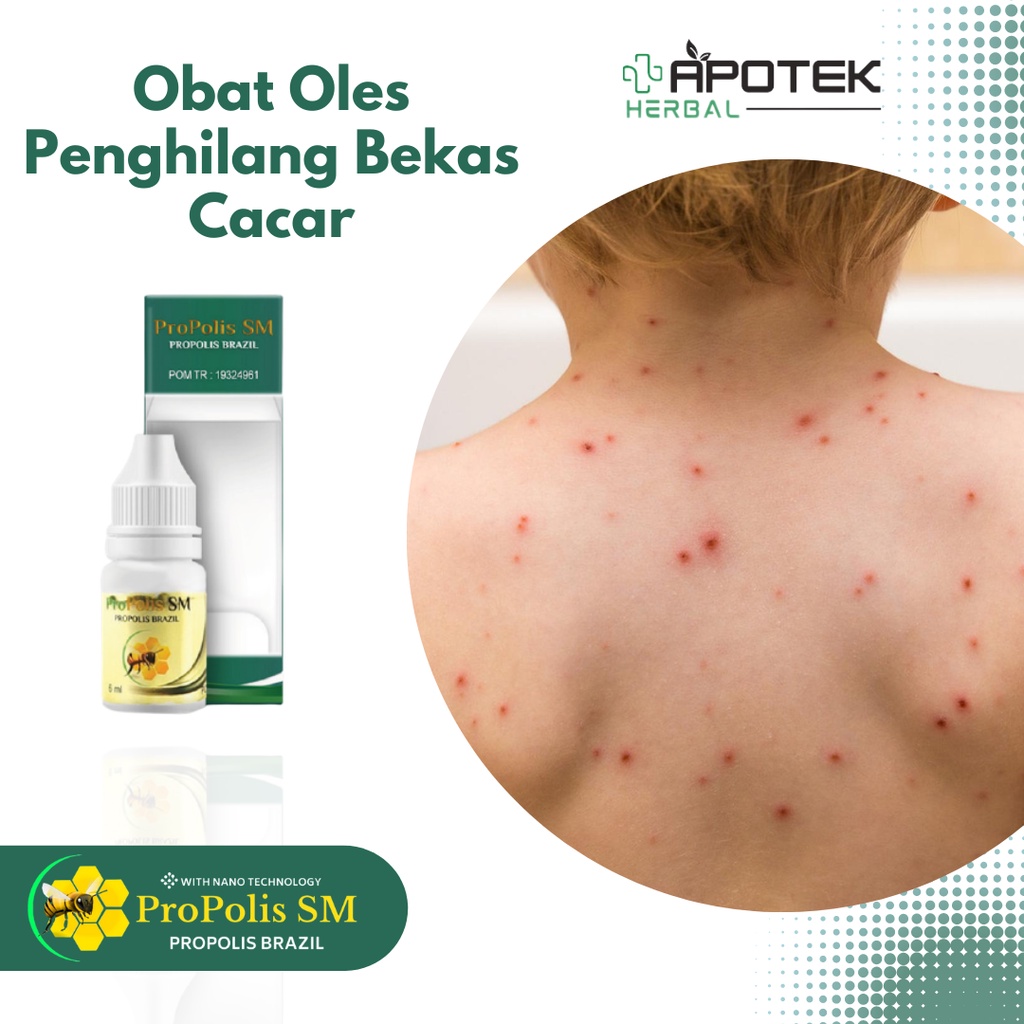 Jual Obat Penghilang Bekas Cacar, Cacar Air di badan & Wajah, Salep ...