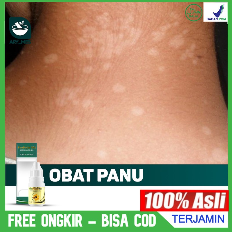 Jual Obat Panu - Kadas - Kurap - Ruam Merah - Gatal Selangkangan ...