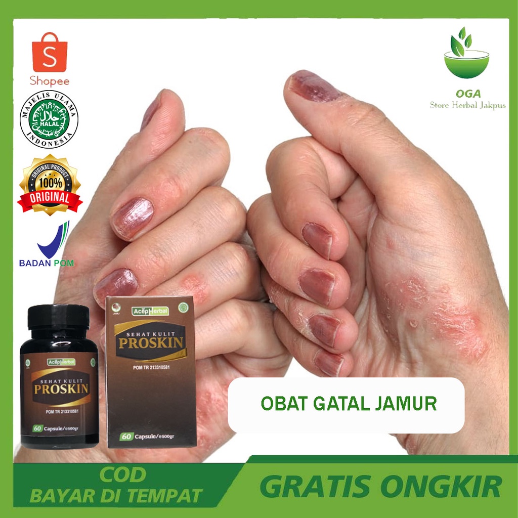 Jual Obat Gatal Jamur Herpes Dermatitis Eksim Impetigo Scabies Budug ...