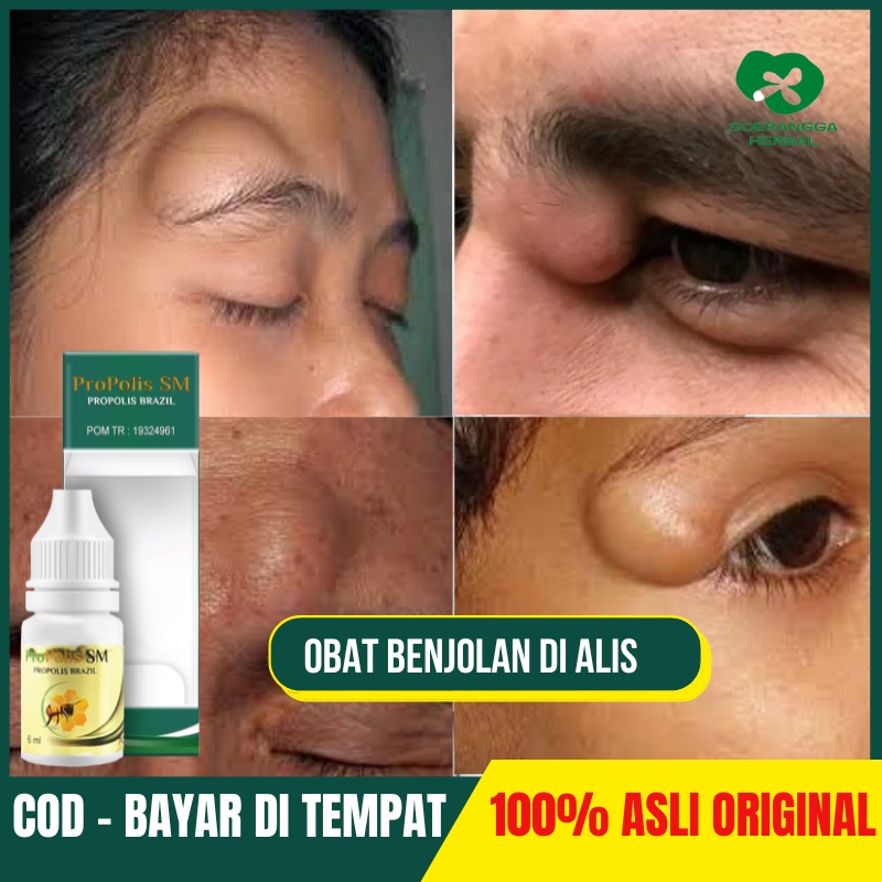 Jual Obat Penghilang Benjolan di Alis, Lipoma, Kelenjar Getah Bening ...