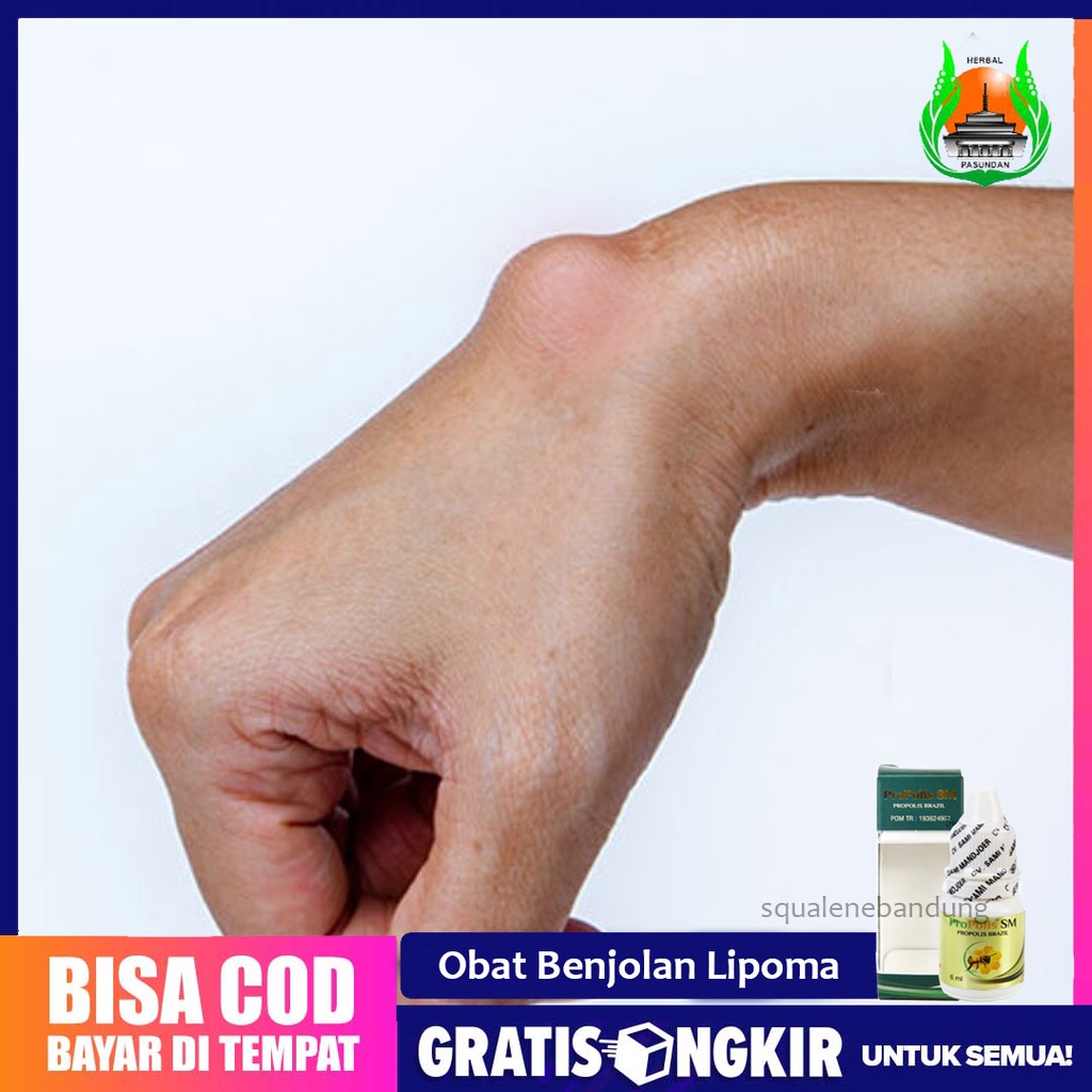 Jual Obat Benjolan Lipoma, Benjolan Lemak di Leher, Lengan, Bahu dan ...