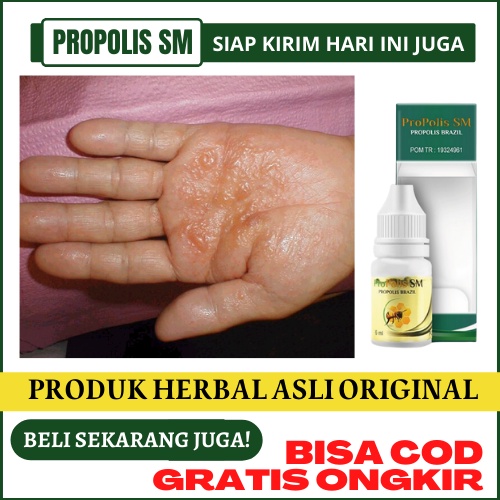 Jual Obat Kuman Air Di Tangan, Mengobati Kutu Air Membandel, Bintik ...
