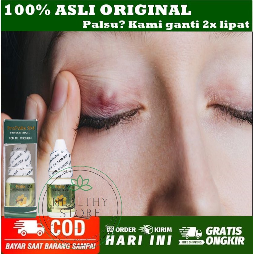 Jual Obat Oles Kalazion - Obat Pengempis Mata Bintitan - Benjolan di ...