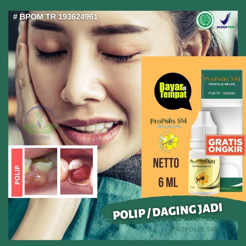 Jual OBAT POLIP PULPA GIGI, BENJOLAN DI GIGI BERLUBANG BAU, TONSIL GIGI ...