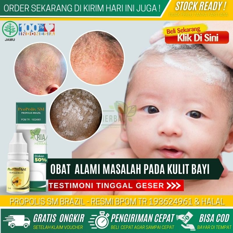 Jual OBAT PENGHILANG KULIT KEPALA BAYI BERKERAK, MENGHILANGKAN KULIT ANAK BERSISIK, PEMBERSIH ...