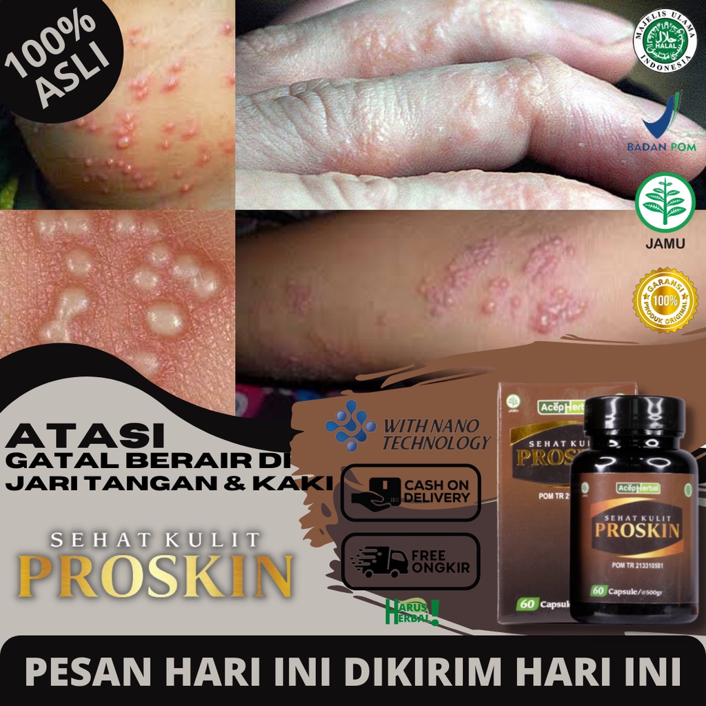 Jual Obat Kulit Gatal Berair, Obat Beruntusan Bening Di Jari Tangan ...