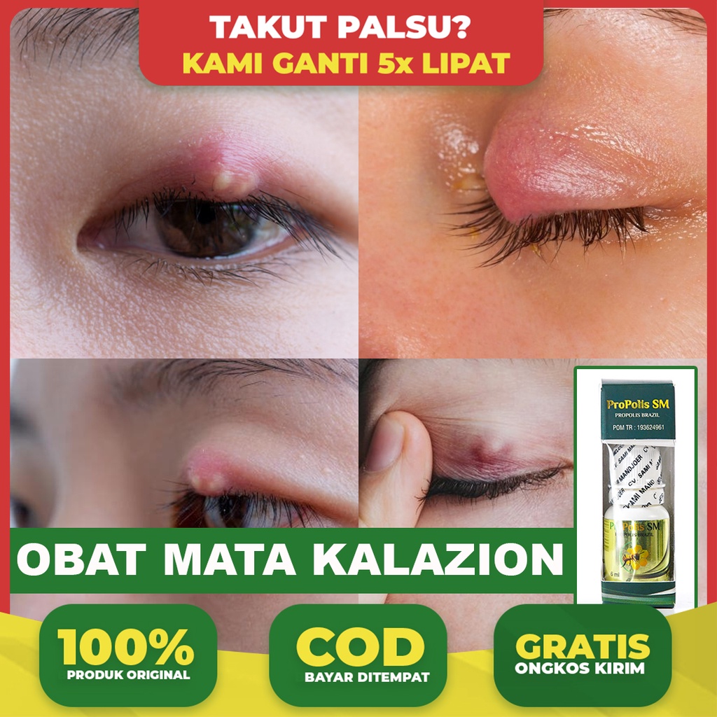 Jual Obat Mata Kalazion - Benjolan di Kelopak Mata - Pengempis Mata ...