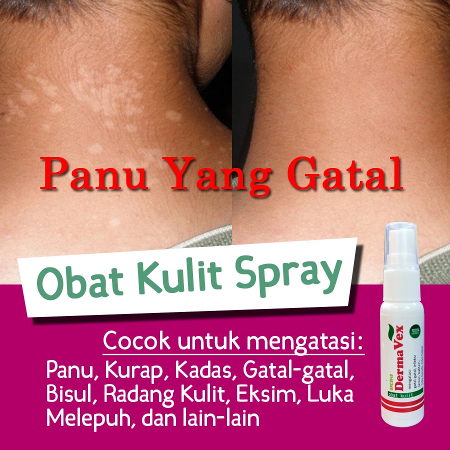 Jual Obat Kulit Gatal Panu Dermavex 25ml | Shopee Indonesia