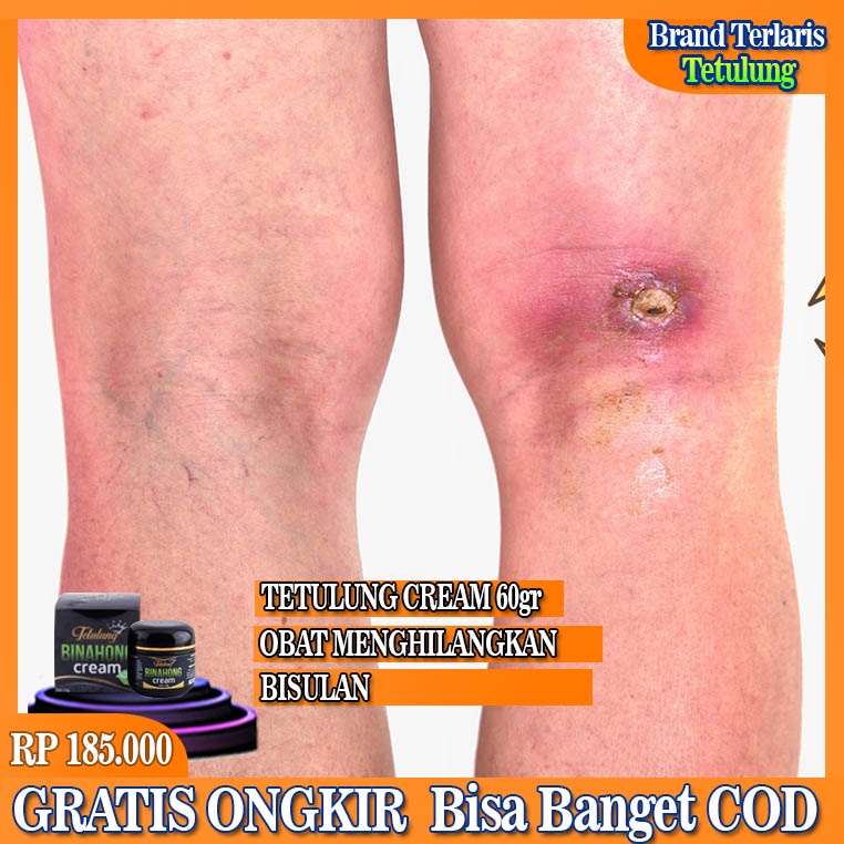 Jual Tetulung Cream 60gr, Cream Untuk Bisulan, Cream Untuk Bisul ...