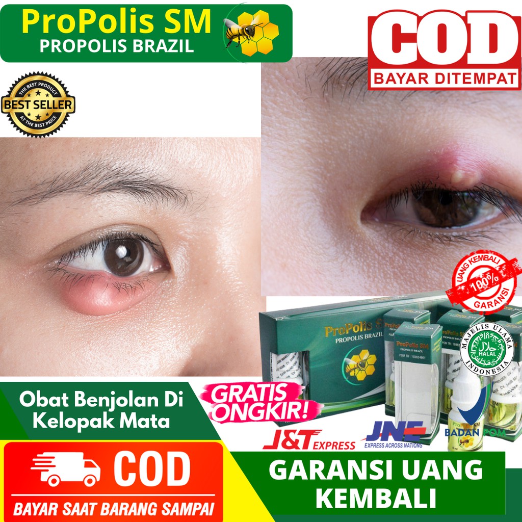 Jual Obat Benjolan Di Kelopak Mata, Obat Benjolan Kalazion, Obat Oles ...