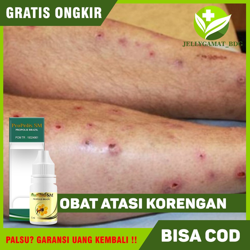 Jual Obat Korengan di Kaki - Korengan di Kepala - Korengan di Wajah ...