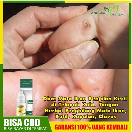 Jual Obat Mata Ikan Benjolan Kecil di Telapak Kaki / Tangan, Herbal ...