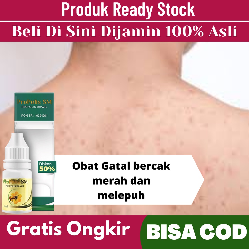Jual Obat Gatal bercak merah dan melepuh , Gatal Kulit Mengelupas ...