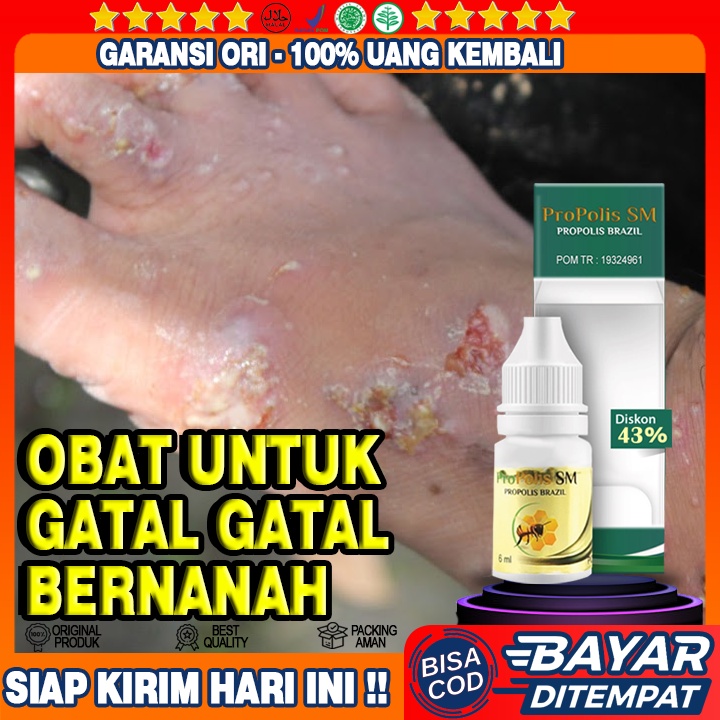 Jual Obat Gatal Bernanah, Eksim, Gudig, Obat Budug Kuman Air, Obat ...