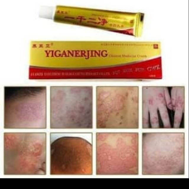 Jual OK BANDUNG*YIGANERJING cream eksim psoriasis dermatitis jerawat ...