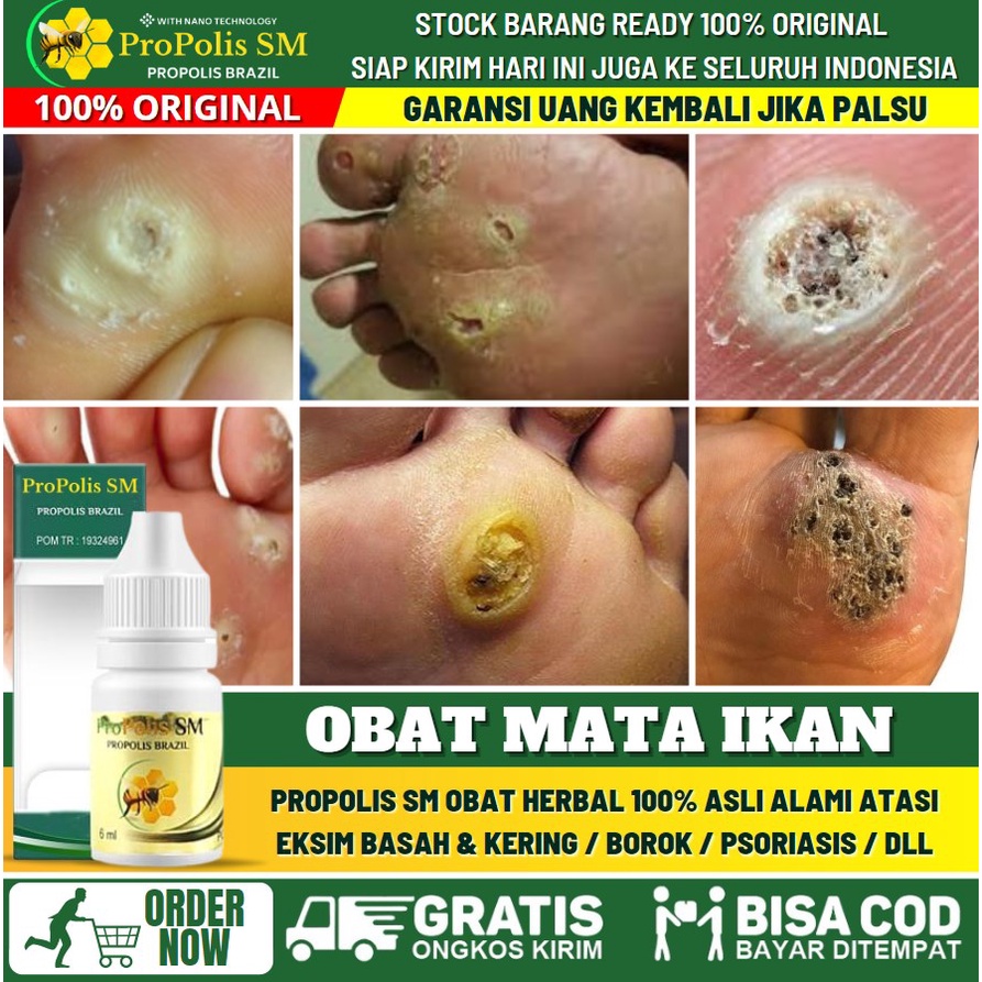 Jual OBAT KHUSUS MATA IKAN / CLAVUS DI TELAPAK KAKI & TANGAN - PERONTOK MATA IKAN SAMPAI KE AKAR ...