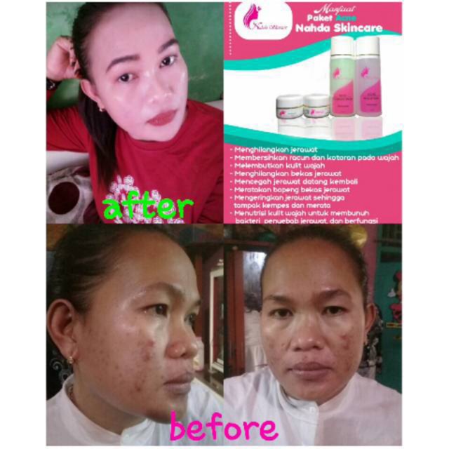 Nahda skincare acne store