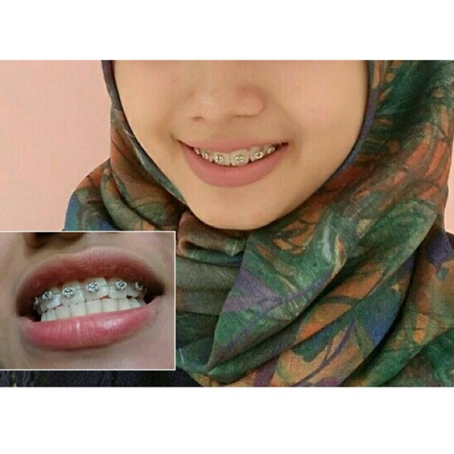 Jual Behel Atas+Bawah Gratis Box+Karet | Shopee Indonesia