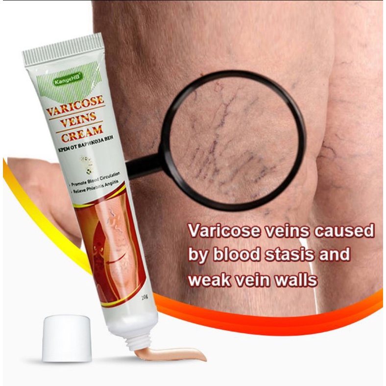 Jual OBAT VARISES OBAT PARISES VARICOSETE | Shopee Indonesia