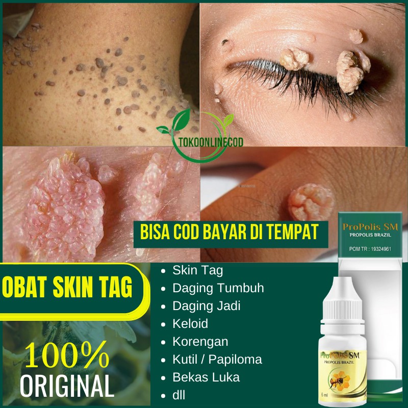 Jual Obat Penghilang Skin Tag Daging Tumbuh di Kulit di Wajah di Leher ...