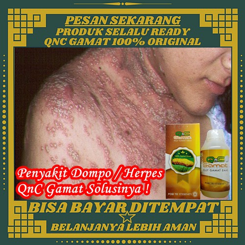 Jual Obat Penyakit Dompo / Herpes Zoster / Cacar Air Herbal 100% Alami ...