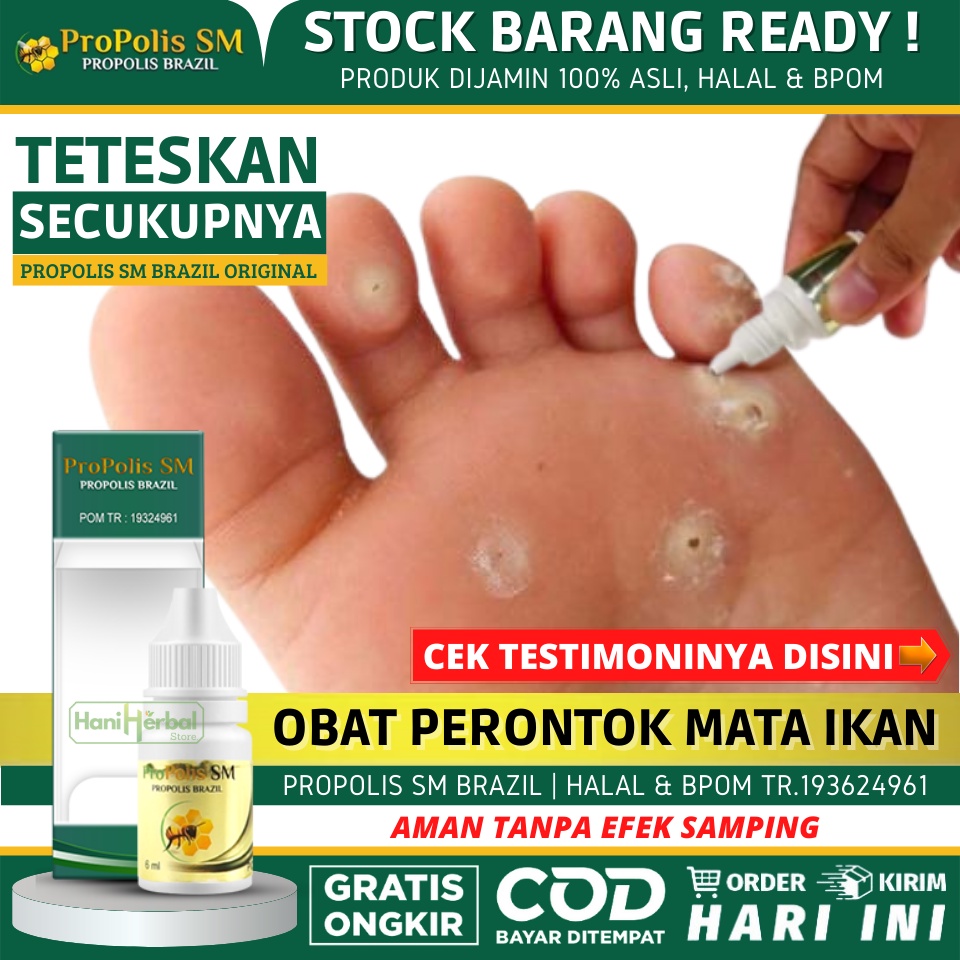 Jual Obat Oles Mata Ikan di Telapak Kaki, Perontok Mata Ikan, Cairan ...