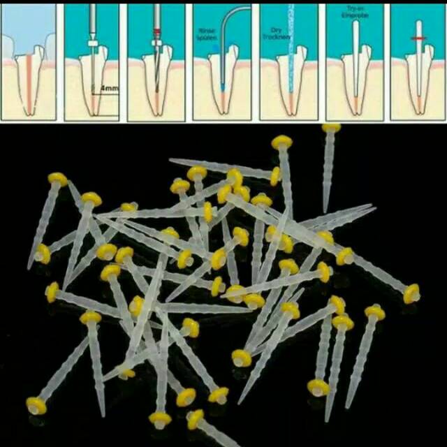 Jual Pasak fiber post / fiber post / post core | Shopee Indonesia