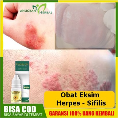 Jual Obat Eksim, Obat Herpes, Obat Sifilis - Herbal Tetes/Oles ...