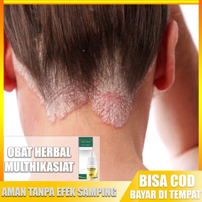 Jual Obat Ketombe Berkerak, Koreng di Kulit Rambut Kepala, Obat Kulit Kepala Bersisik, Kering ...