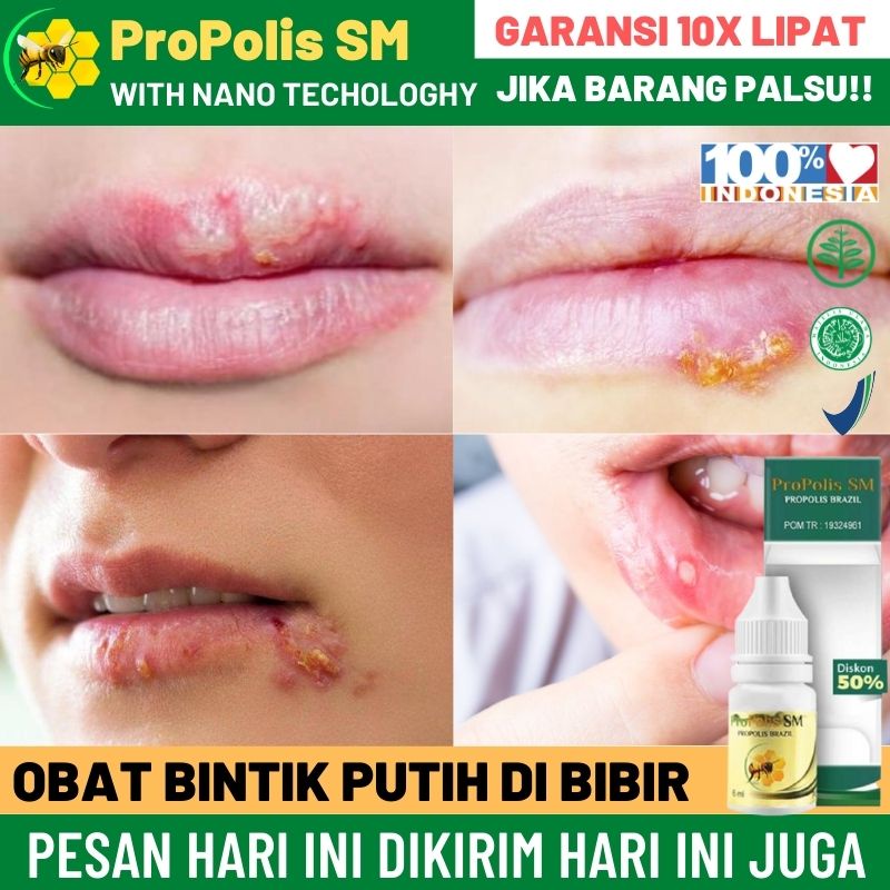 Jual Obat Penghilang Bintik Putih di Bibir, Fordyce Spots / Bintik ...