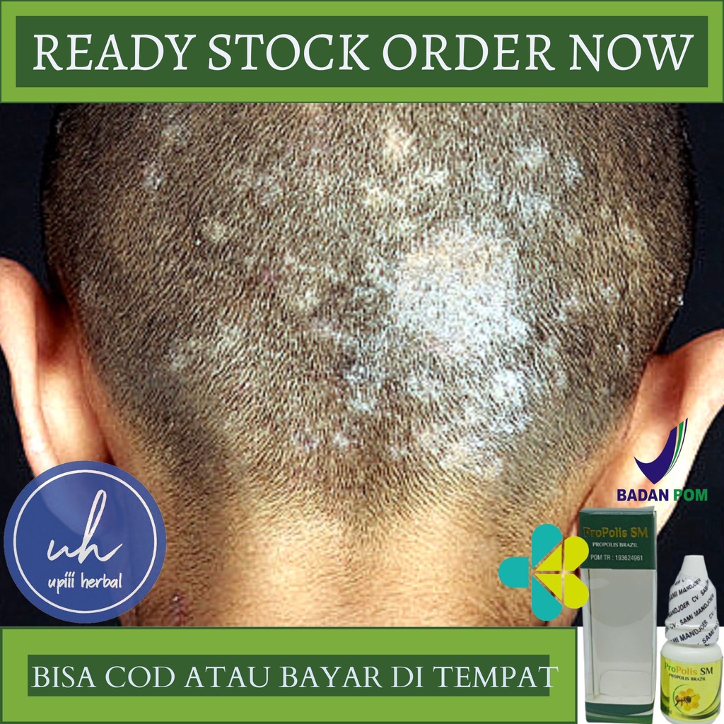 Jual OBAT JAMUR DIKEPALA ANAK, OBAT JAMUR KEPALA (TINEA KAPITIS), OBAT ...