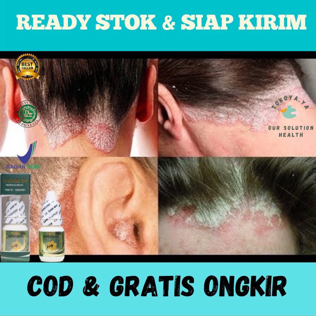 Jual PROPOLIS SM 100% ORIGINAL BPOM, Obat Penghilang Ketombe Berkerak, Obat Penghilang Gatal Di ...