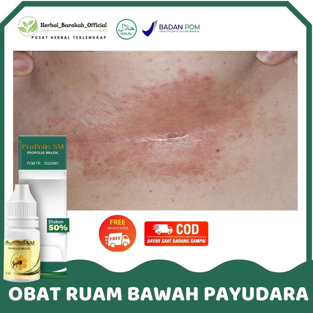 Jual Obat Ruam Merah Di Bawah Payudara , Biang Keringat , Gatal , Panas ...