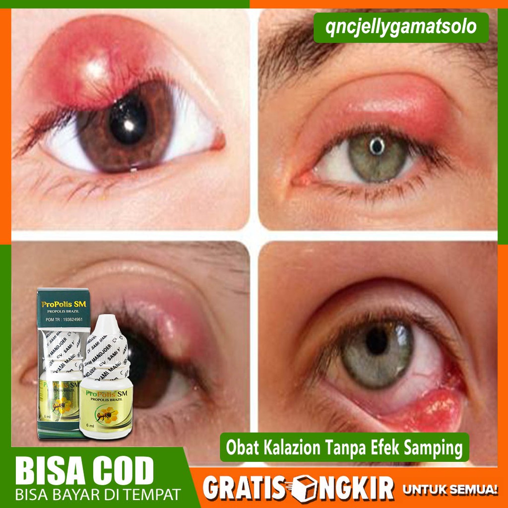 Jual Obat Benjolan Kalazion di Kelopak Mata - Sakit Mata - Mata ...