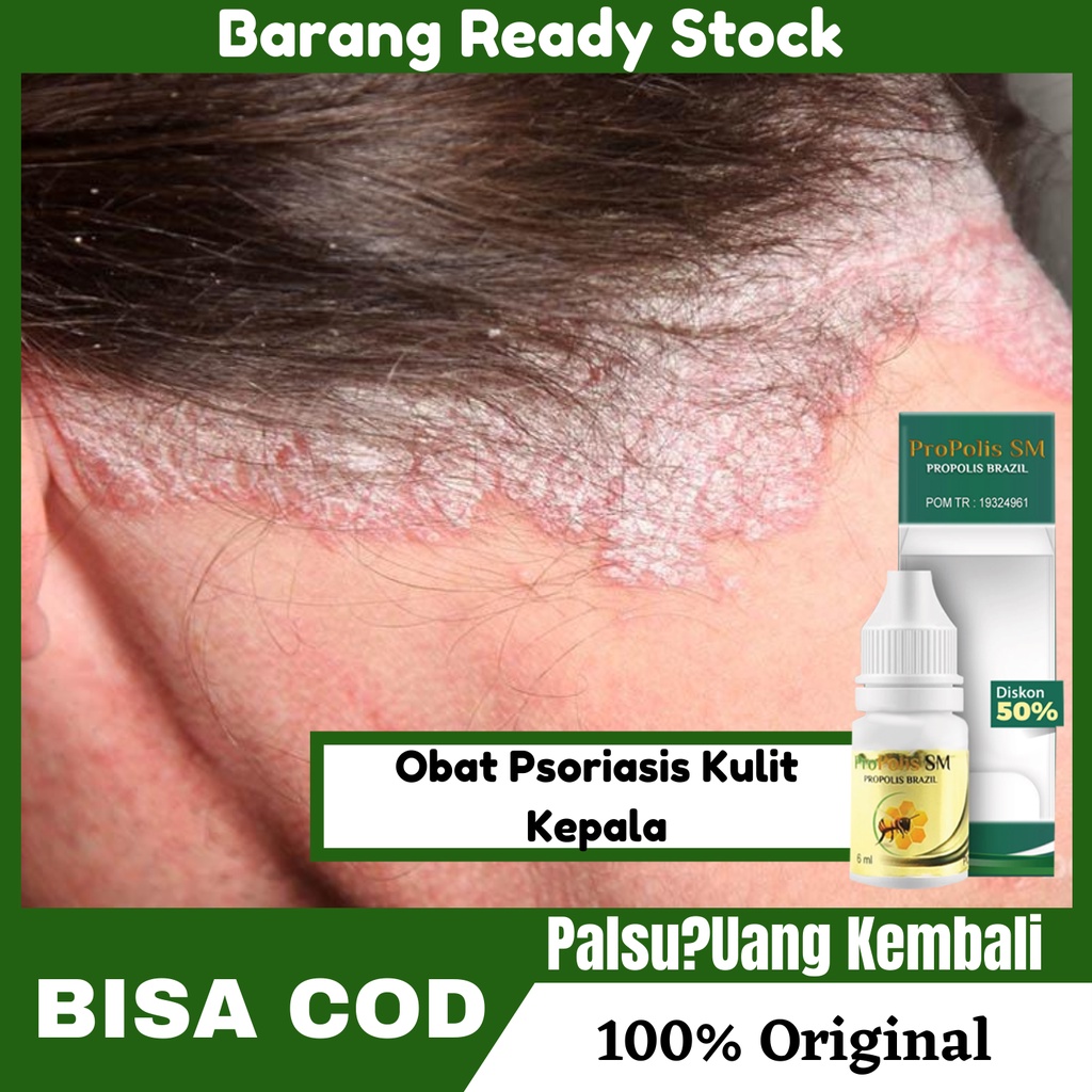 Jual Obat Psoriasis Kulit Kepala , Kulit Bersisik , Kulit Kepala Kering , Ruam Di Kulit Kepala ...