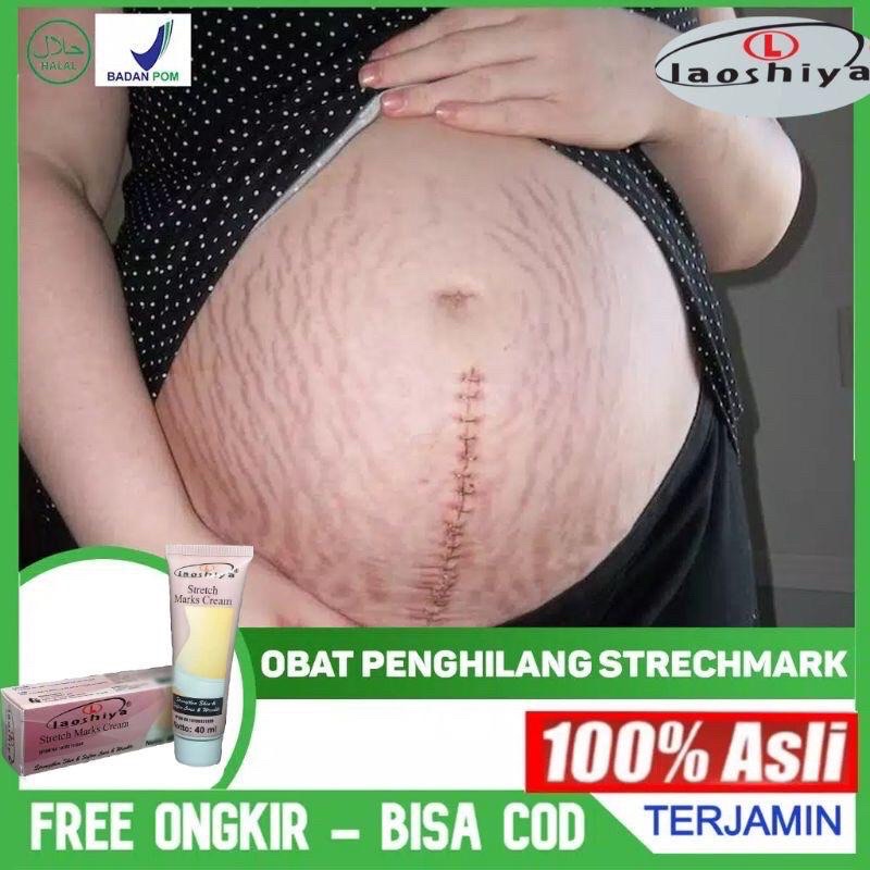 Jual Penghilang Strechmark cream salep penghilang bekas luka keloid ...