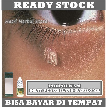 Jual Obat Papiloma 100% Alami, Penghilang Papiloma, Pengempis Papiloma ...