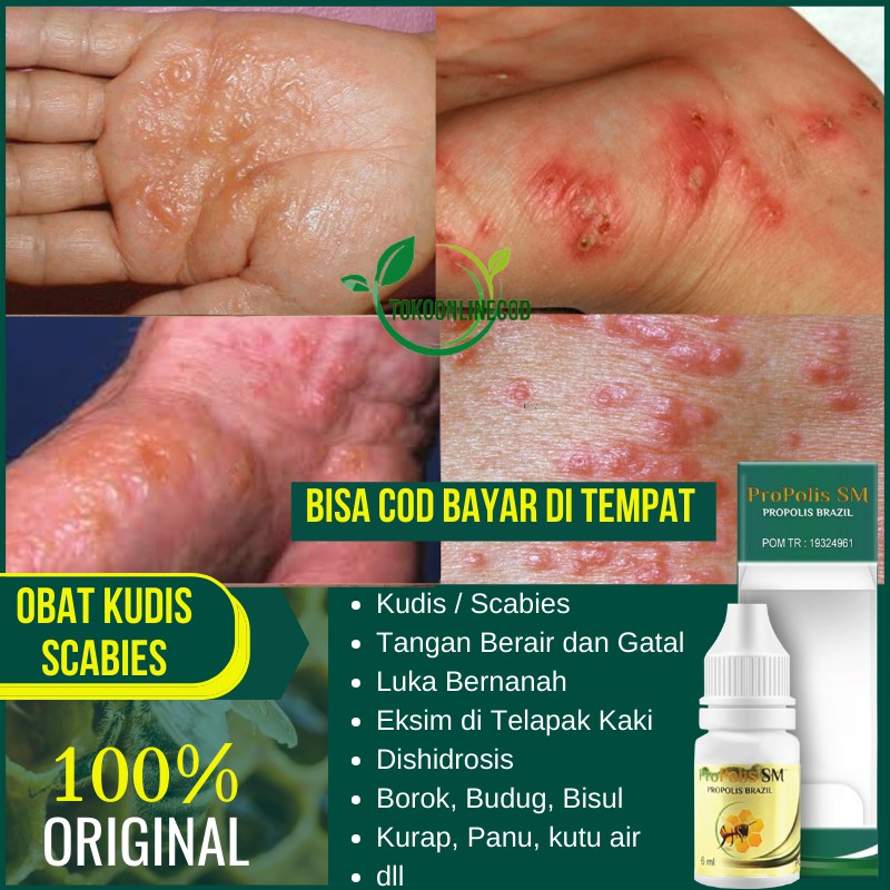 Jual Obat Kudis Scabies, Tangan Berair dan Gatal, Luka Bernanah, Eksim ...