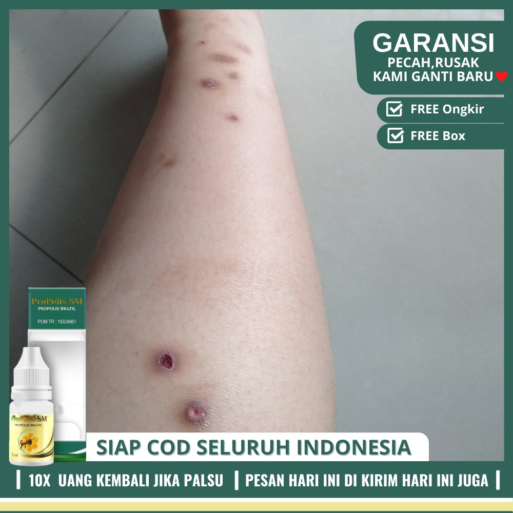 Jual Obat Darah Manis / Amis, Prurigo, Bintil-Bintil Bernanah - Obat ...