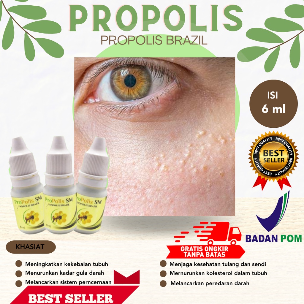 Jual Obat Kutil, Skin Tag, Milia, Daging Jadi, Mata Ikan, Lipoma ...