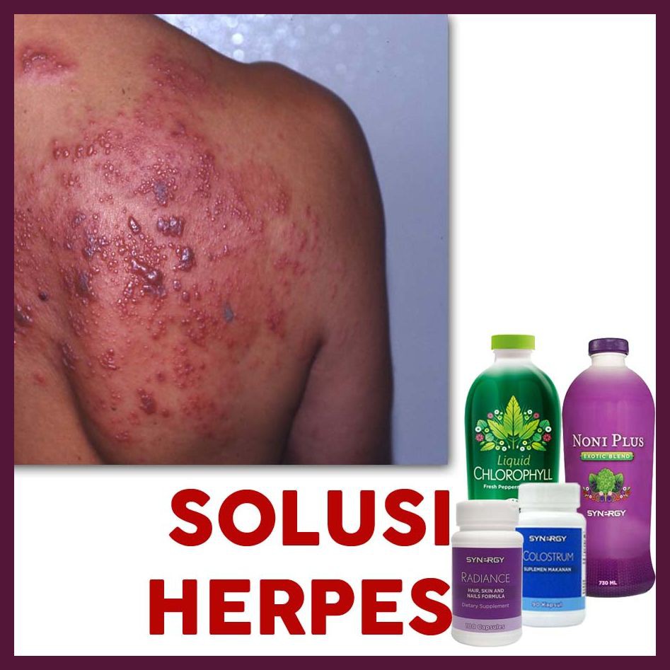 Jual Herbal Obati Cacar Ular / Herves / Dompo Dewasa & Remaja | Shopee ...