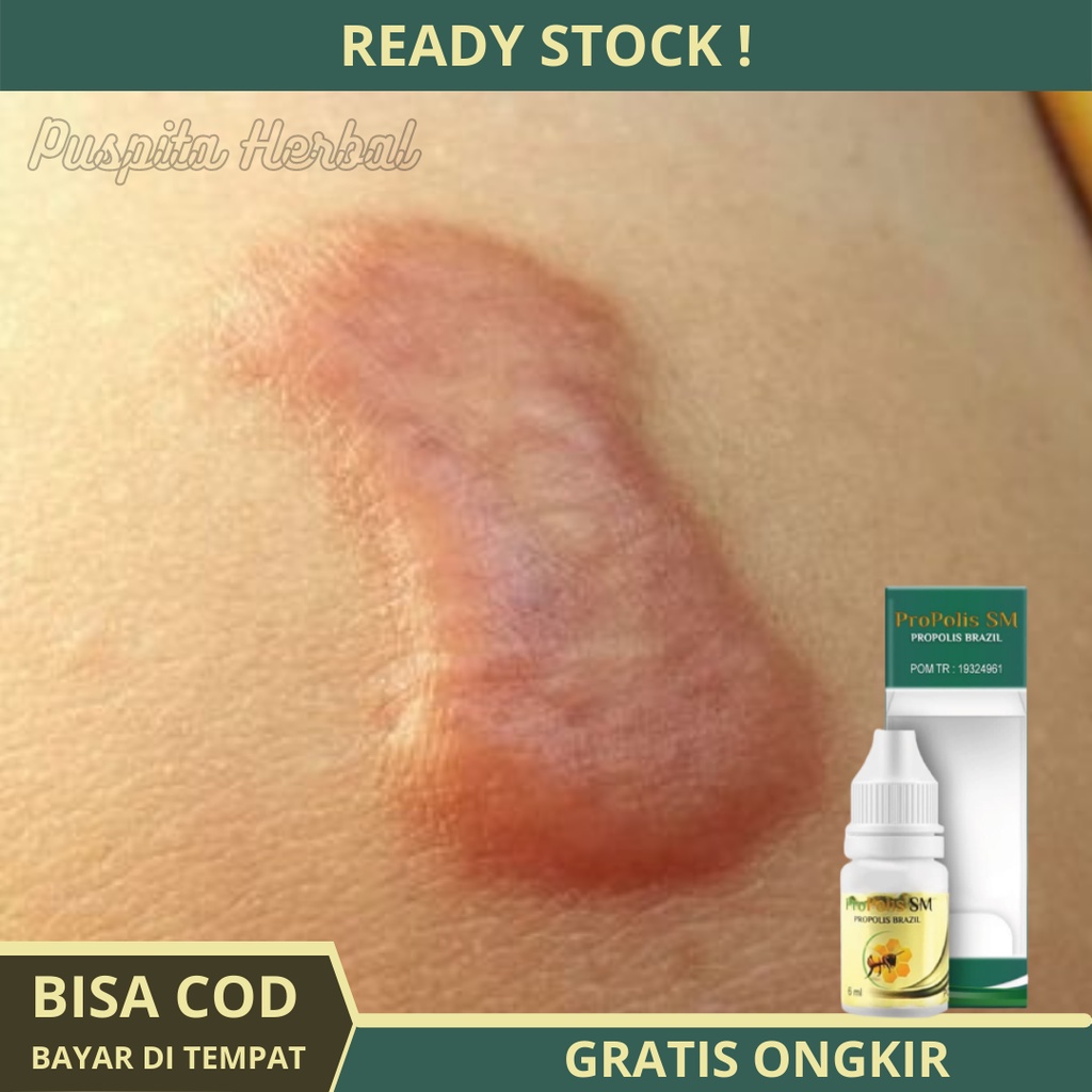 Jual Obat Keloid, Obat Penghilang Keloid, Obat Keloid Daging Tumbuh ... Jual Obat Keloid, Obat Penghilang Keloid, Obat Keloid Daging Tumbuh ...