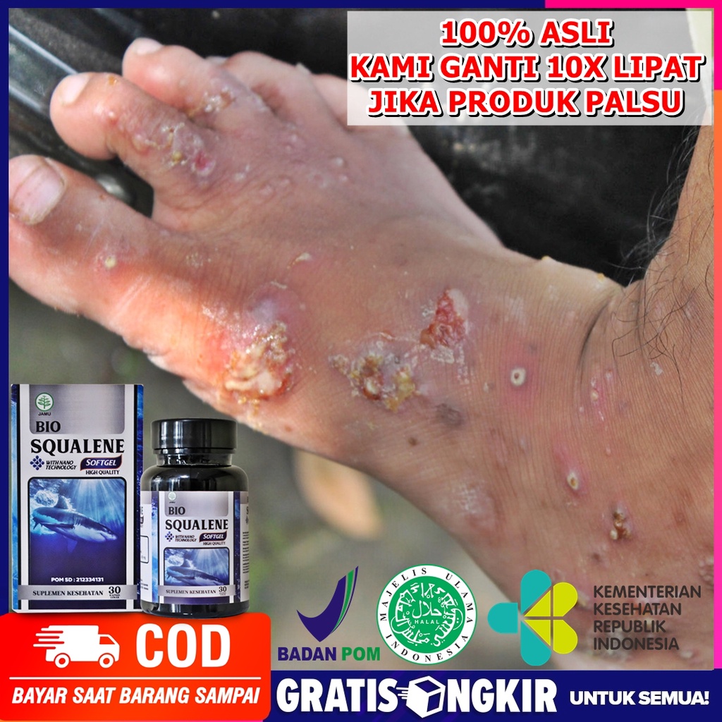 Jual Penghilang Budug / Borok di Kaki - Budug Bernanah & Gatal Kulit ...
