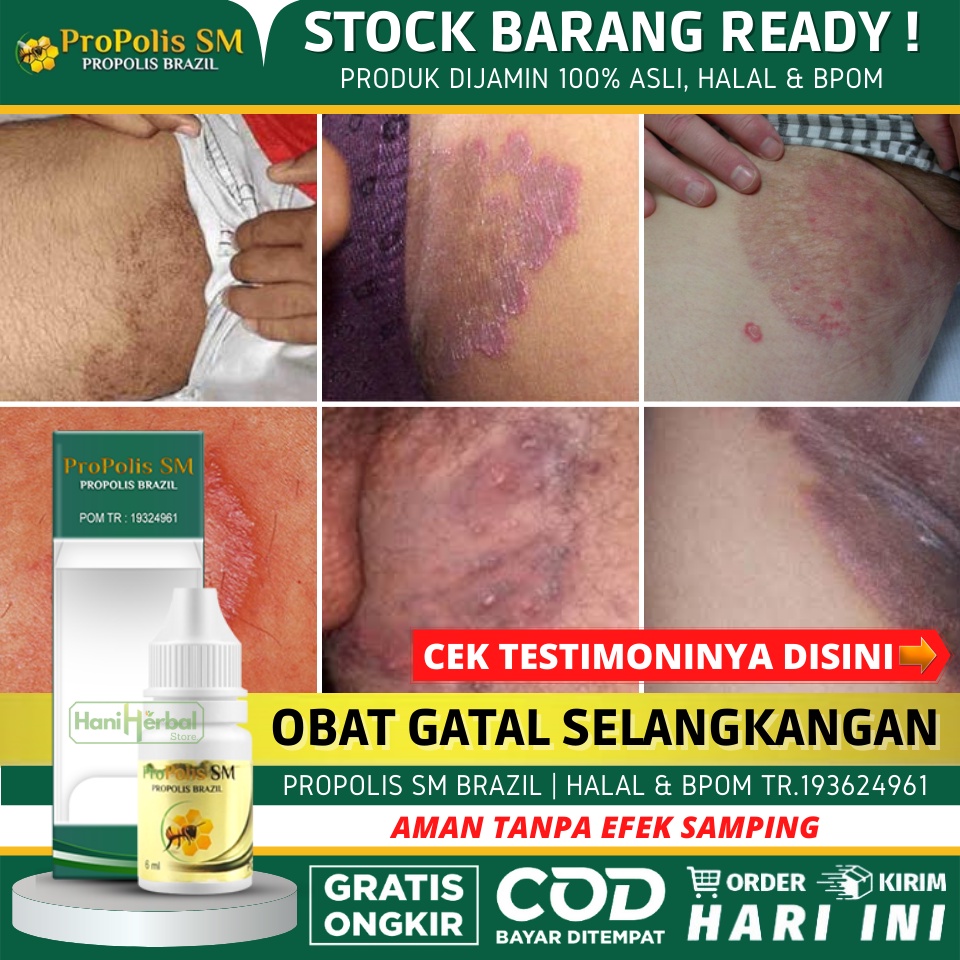 Jual Obat Oles Untuk Gatal Gatal di Selangkangan, Selangkangan Bruntusan, Bokong Bruntusan ...