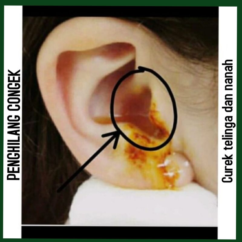 Jual PENGHILANG CONGE CUREK TELINGA DAN NANAH PERMANEN | Shopee Indonesia