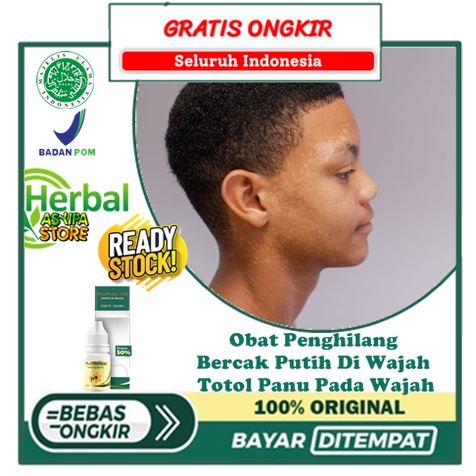 Jual Obat Penghilang Bercak Putih Di Wajah - Totol Panu Pada Wajah ...